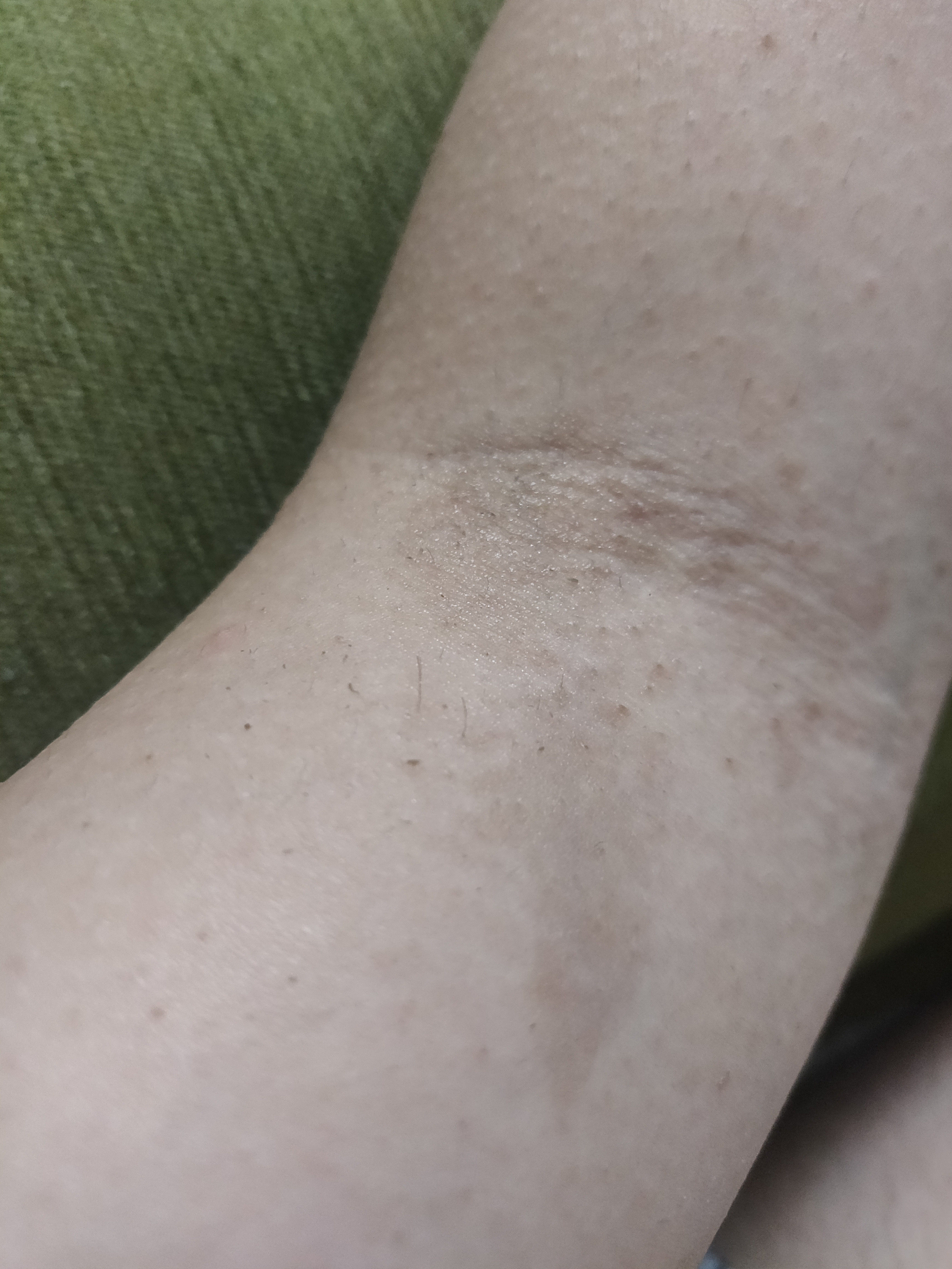 Dry Skin Patches On Elbows